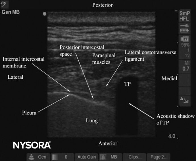 Tips for the Thoracic Paravertebral Block (Transverse Scan) - NYSORA