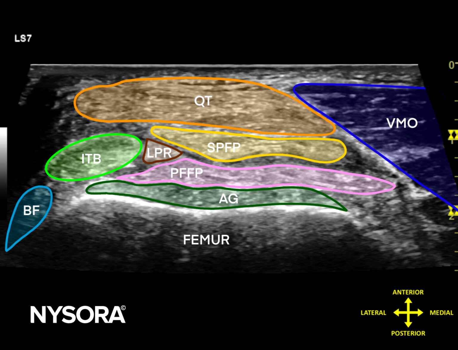 Tips for scanning the quadriceps tendon in a transverse orientation ...