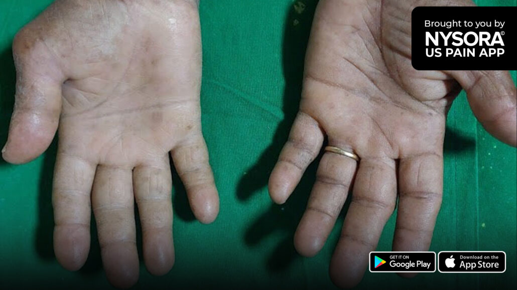 Case study: Carpal tunnel syndrome - Injection - NYSORA