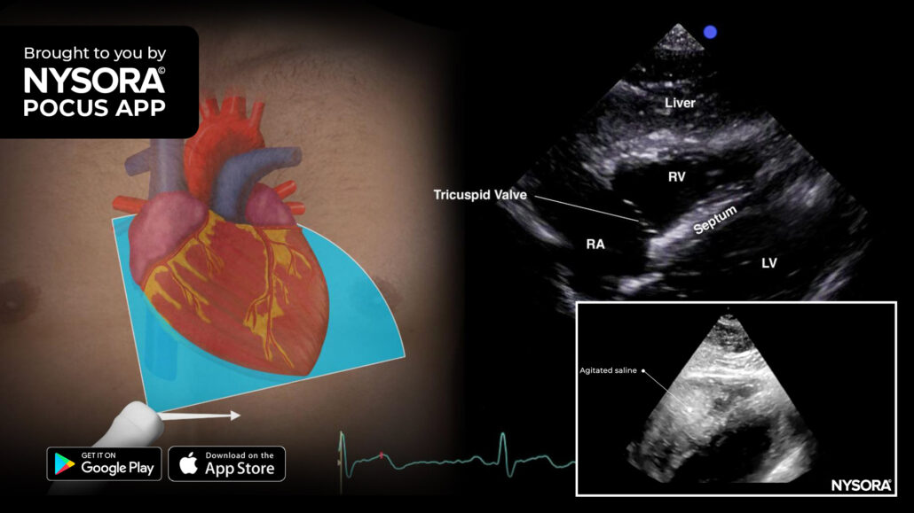 Posición del catéter venoso central - Signo de remolino auricular rápido (RASS) - NYSORA