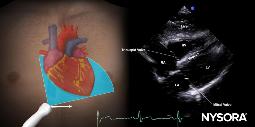 Central venous catheter position - Rapid atrial swirl sign (RASS) - NYSORA
