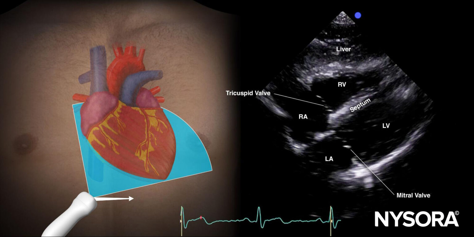 Central venous catheter position - Rapid atrial swirl sign (RASS) - NYSORA