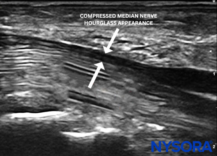 Case study: Carpal tunnel syndrome - Injection - NYSORA
