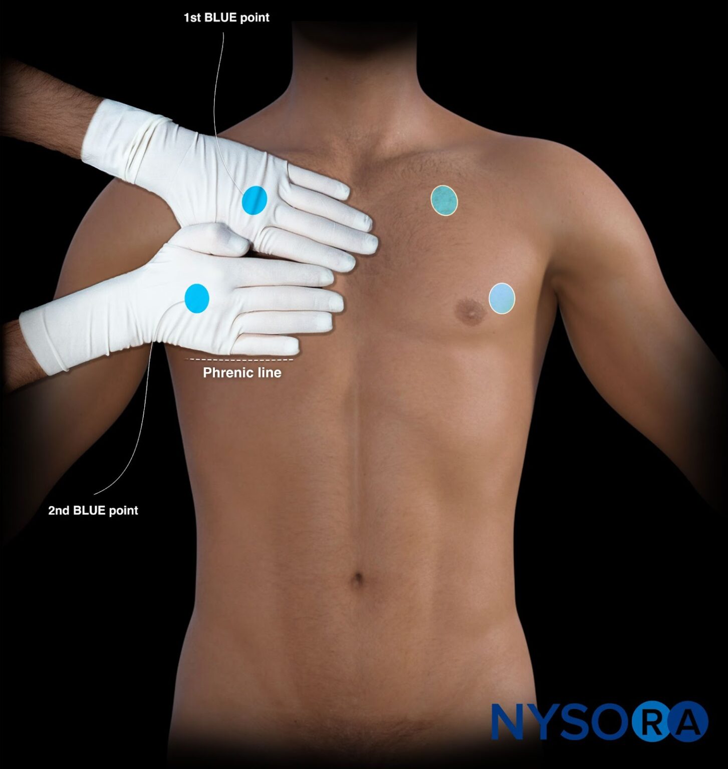Acute respiratory failure: The BLUE protocol - NYSORA