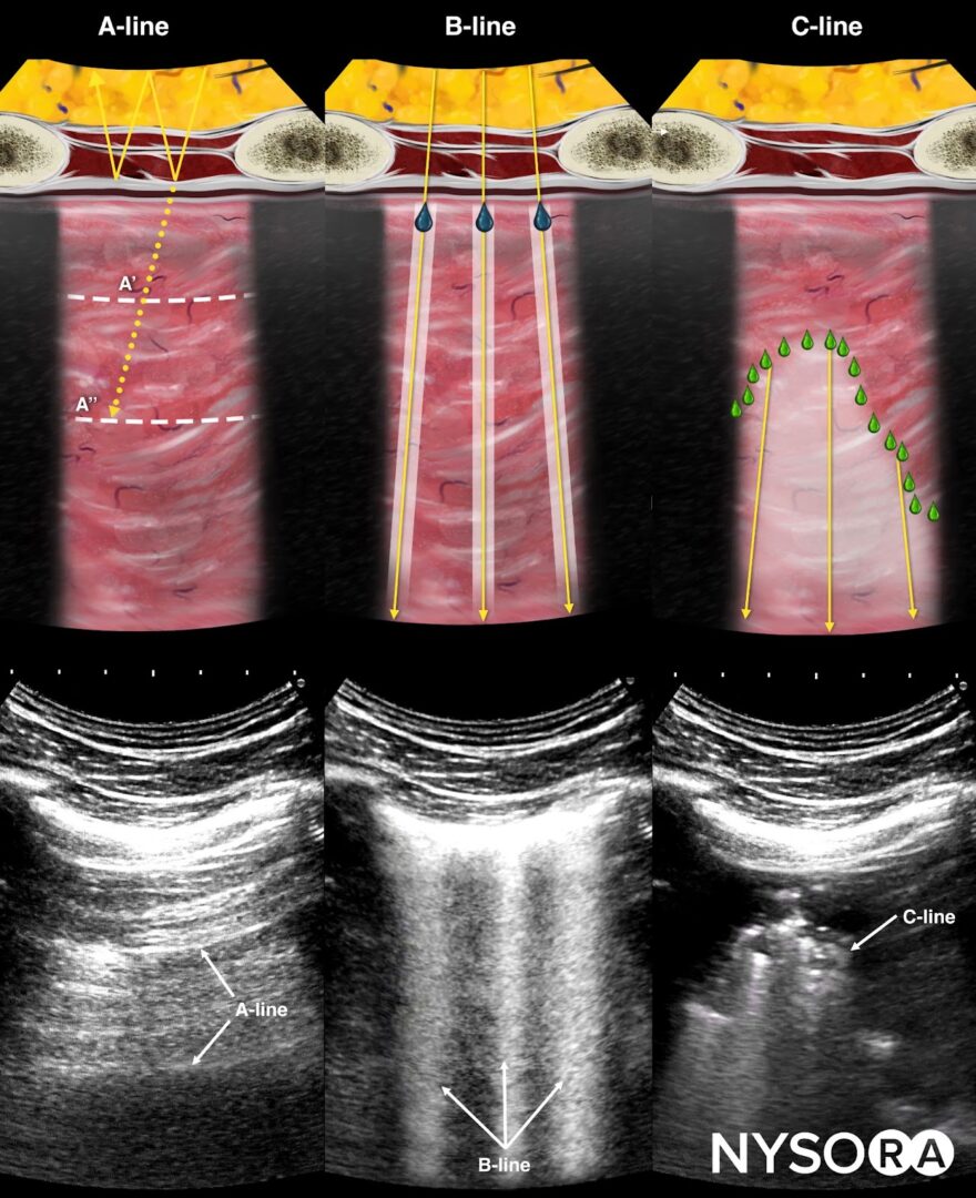 Acute respiratory failure: The BLUE protocol - NYSORA
