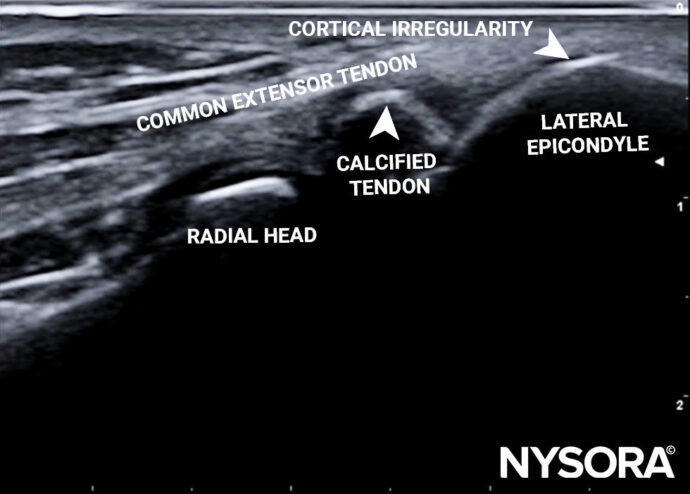 Estudio de caso: Epicondilitis lateral - Inyección - NYSORA