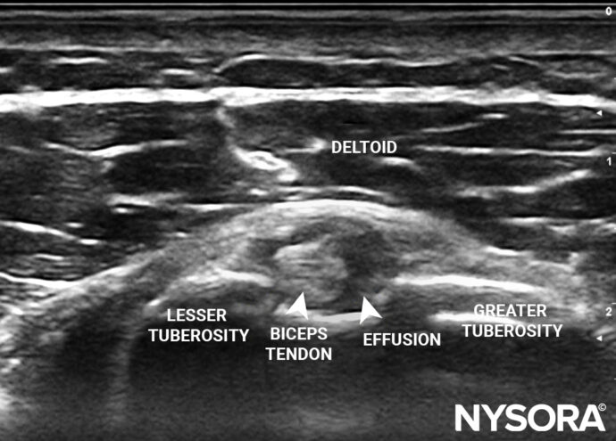 Case study: Biceps tendinopathy - Injection - NYSORA