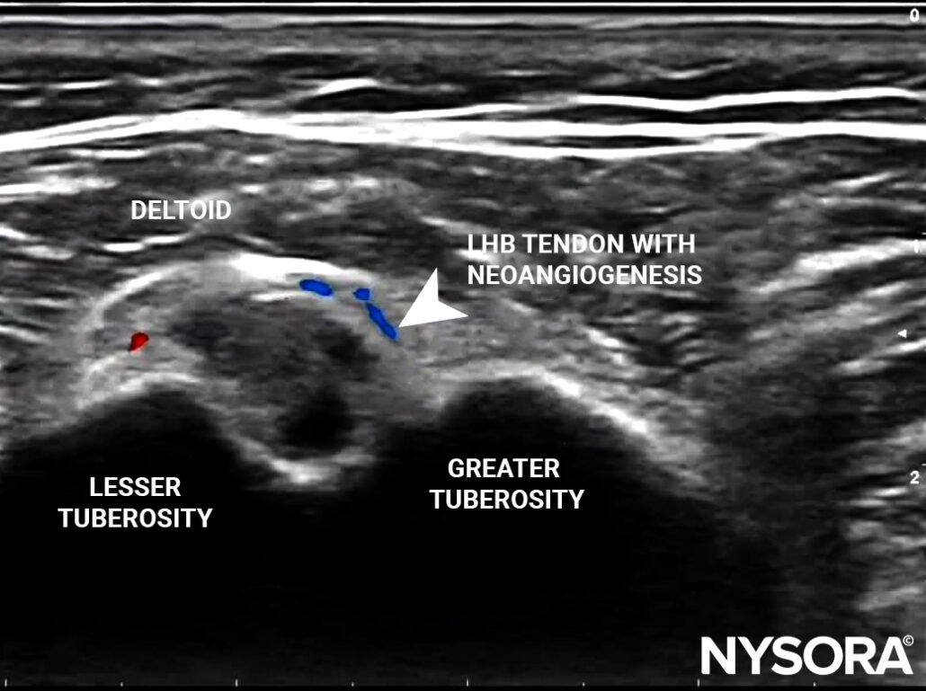 Case study: Biceps tendinopathy - Injection - NYSORA