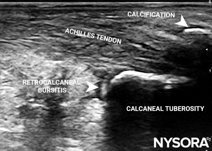 Case study: Plantar fasciopathy - Injection - NYSORA