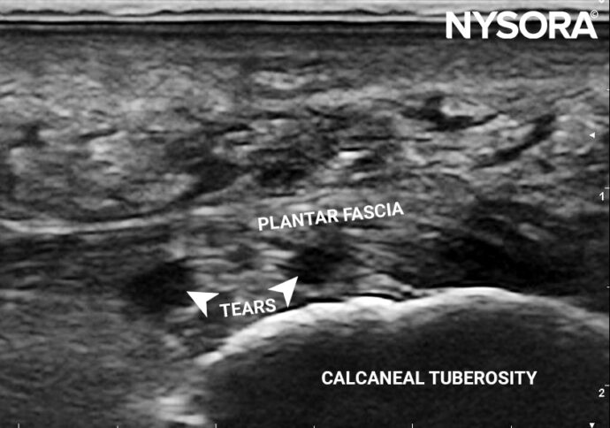 Case study: Plantar fasciopathy - Injection - NYSORA