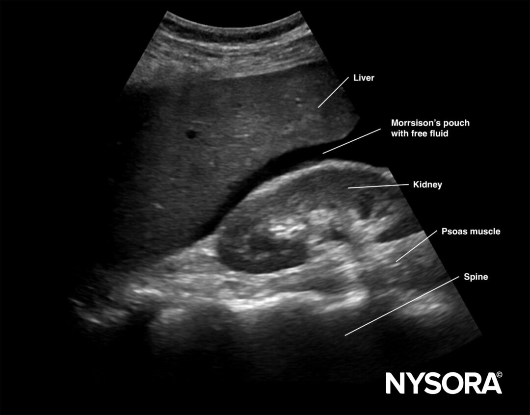 How to detect free intraperitoneal fluid in the right upper quadrant ...
