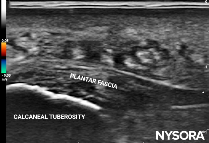 Case study: Plantar fasciopathy - Injection - NYSORA