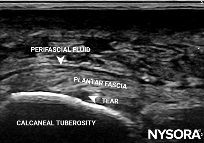 Case study: Plantar fasciopathy - Injection - NYSORA