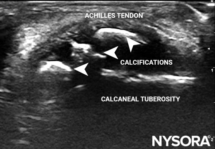 Case study: Plantar fasciopathy - Injection - NYSORA