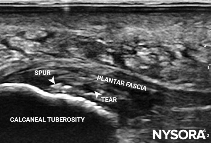 Case study: Plantar fasciopathy - Injection - NYSORA