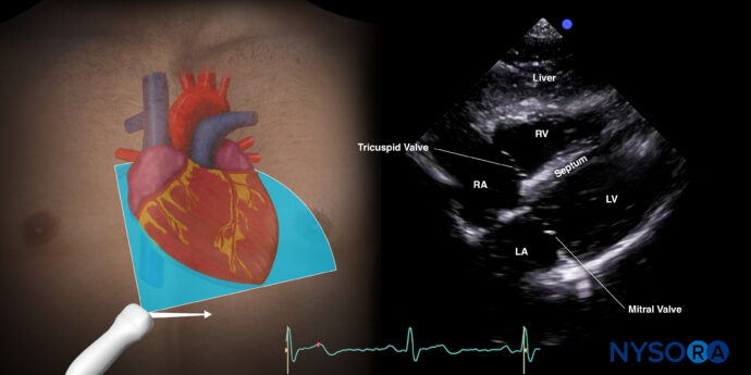 Identifying Pericardial Effusion or Tamponade: A Guide to Ultrasound Assessment in the Subcostal ...
