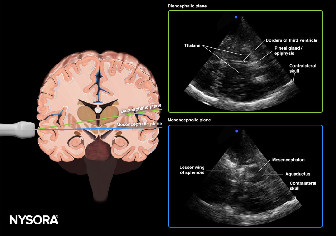 POCUS App Update: The Ultimate Guide to Transcranial Doppler - NYSORA