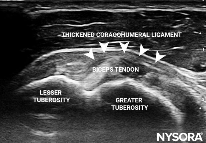 Case Study: Adhesive Capsulitis - Injection - NYSORA