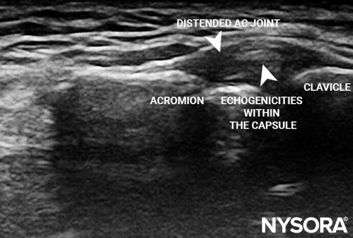 Case Study: Adhesive Capsulitis - Injection - NYSORA