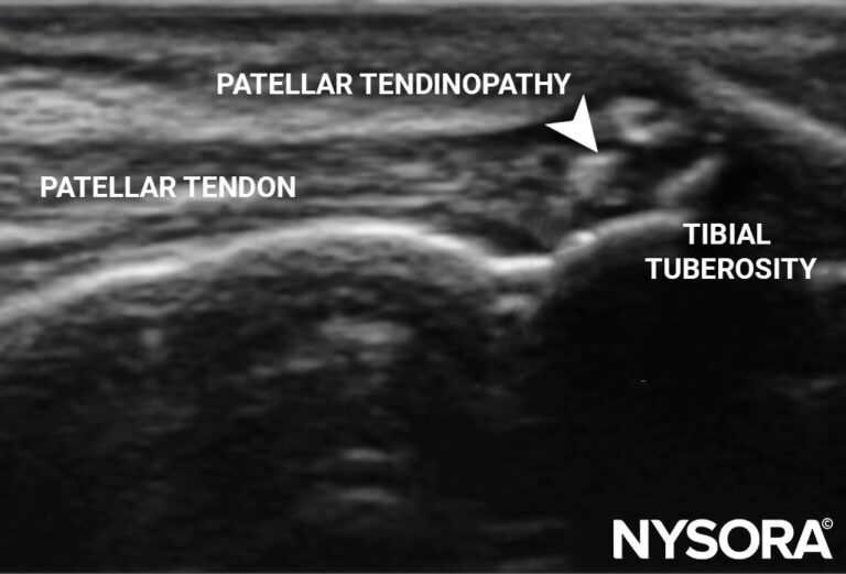 Case study: Pes anserinus bursitis - Injection - NYSORA