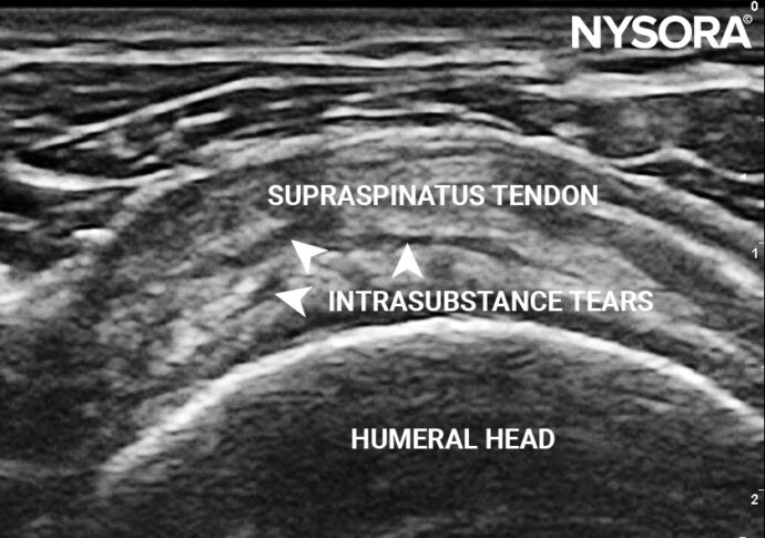 Case Study: Adhesive Capsulitis - Injection - NYSORA