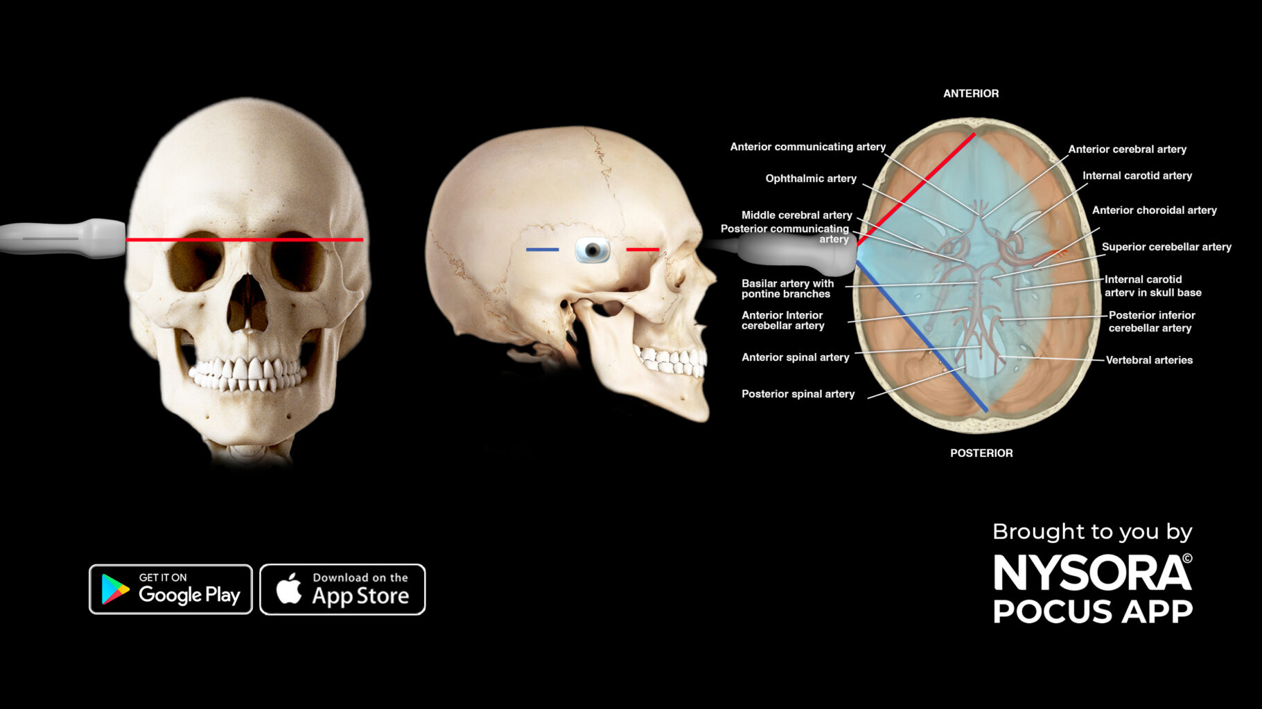 Assessing Cerebral Vasospasm with Transcranial Doppler- A Step-by-Step ...