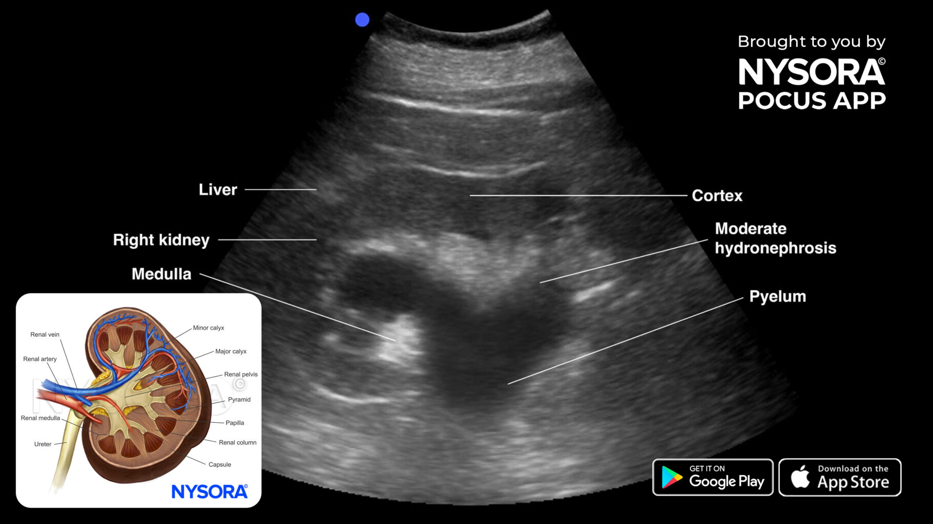 Identifying and Classifying the Severity of Hydronephrosis - NYSORA ...