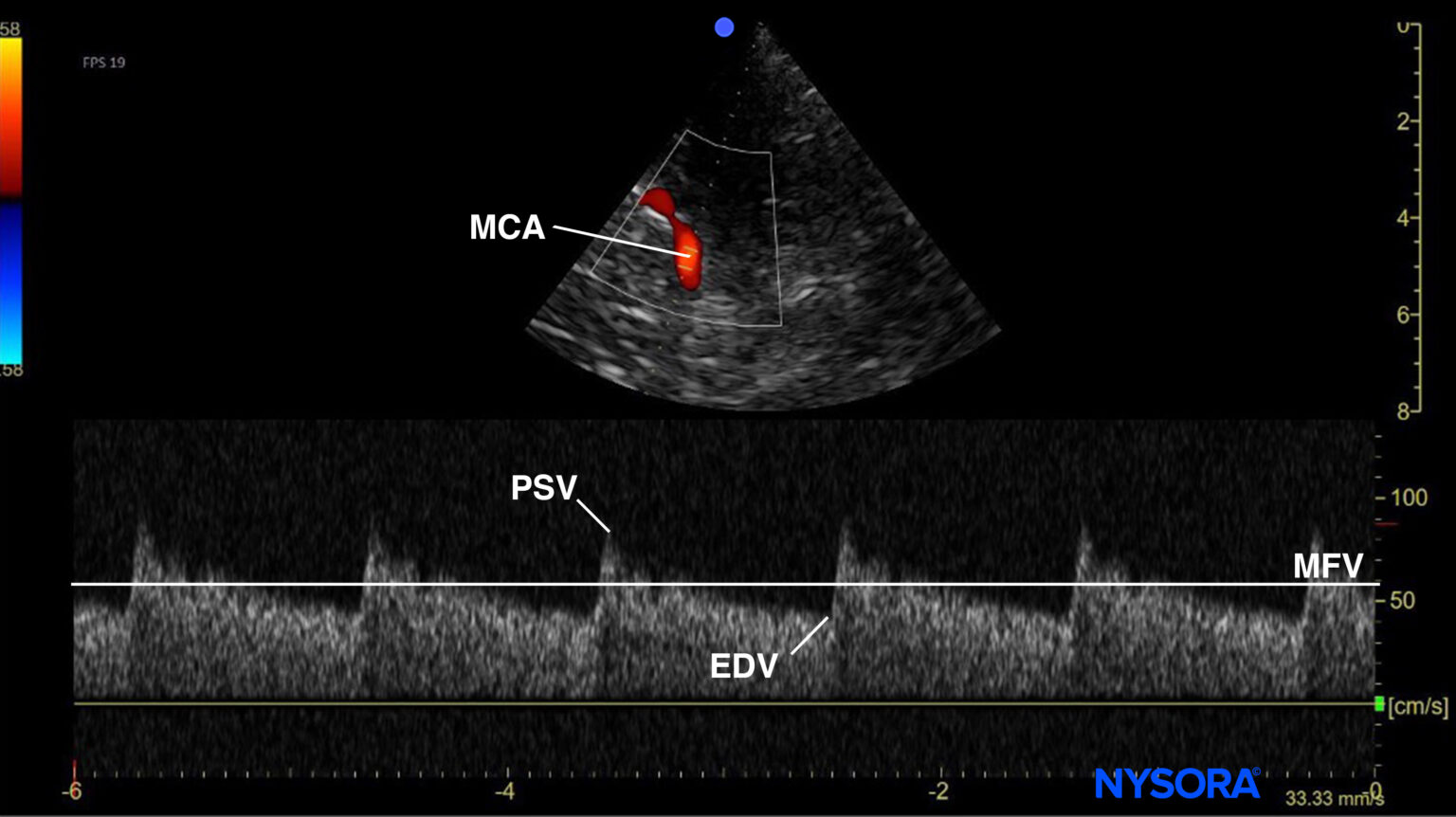 Assessing Cerebral Vasospasm with Transcranial Doppler: A Step-by-Step ...