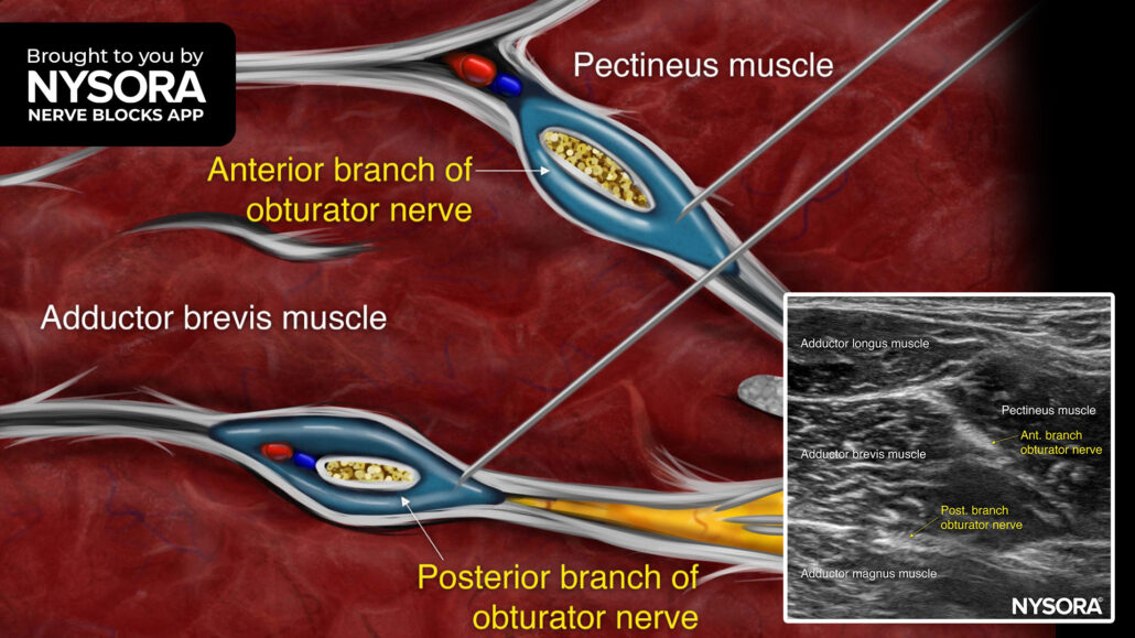 Tips For An Obturator Nerve Block Distal Approach Nysora