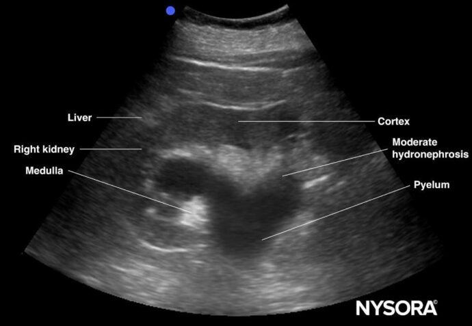 Identifizieren und Klassifizieren des Schweregrads der Hydronephrose ...