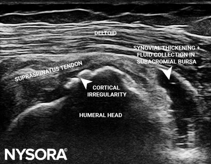 Case study: Rotator cuff tear - Injection - NYSORA