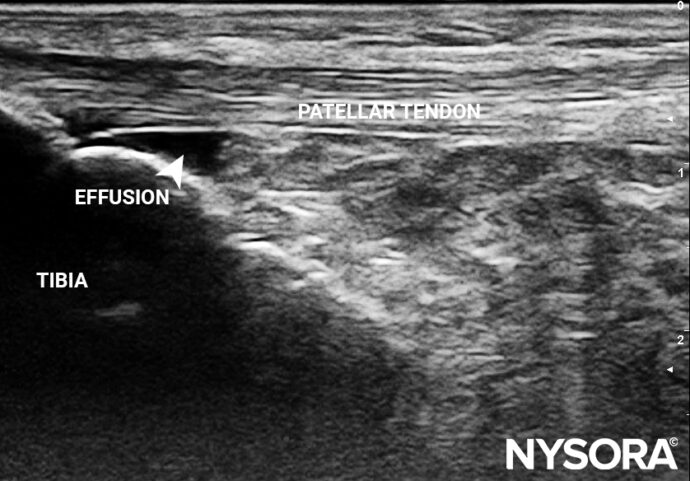 Case study: Baker’s cyst - Injection - NYSORA