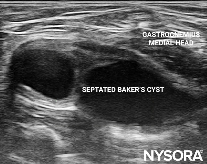 Estudio de caso: Quiste de Baker - Inyección - NYSORA