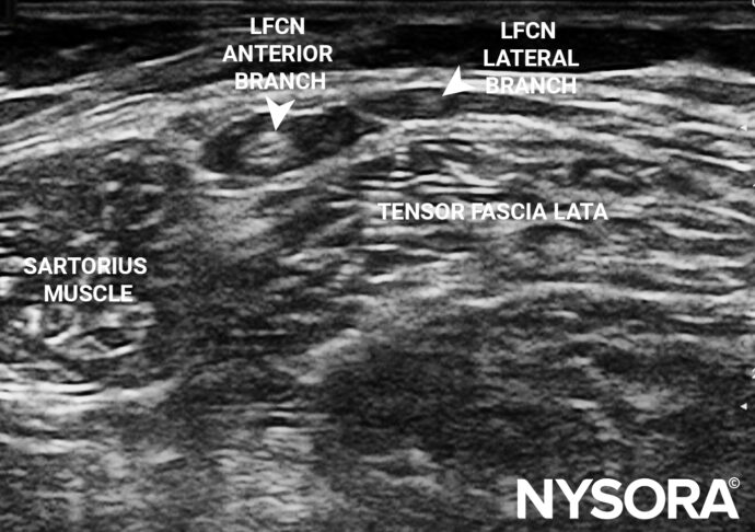 Case study: Meralgia paresthetica - Injection - NYSORA