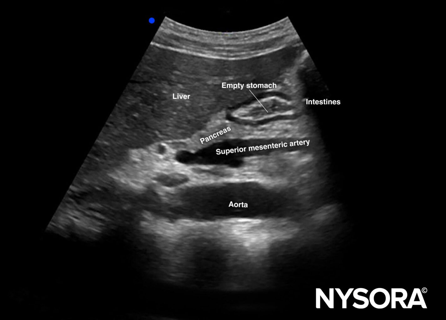 Gastric content assessment for Anesthesia in Emergency Surgery Patients ...