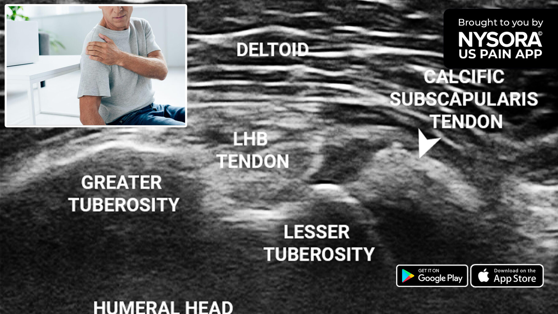 Ultrasound Guided Barbotage Procedure For Calcific