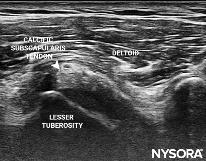 Case study: Calcific tendinitis - Barbotage - NYSORA