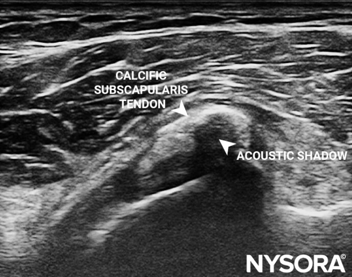 Case study: Calcific tendinitis - Barbotage - NYSORA