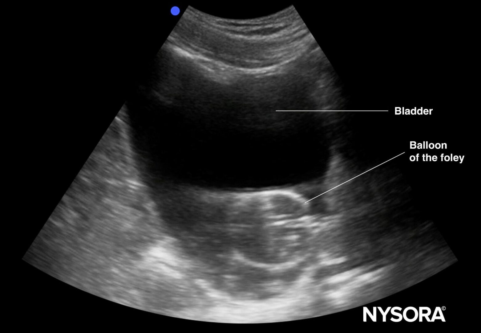 Ultrasound for Foley Catheter: Positioning & Obstruction Identification ...