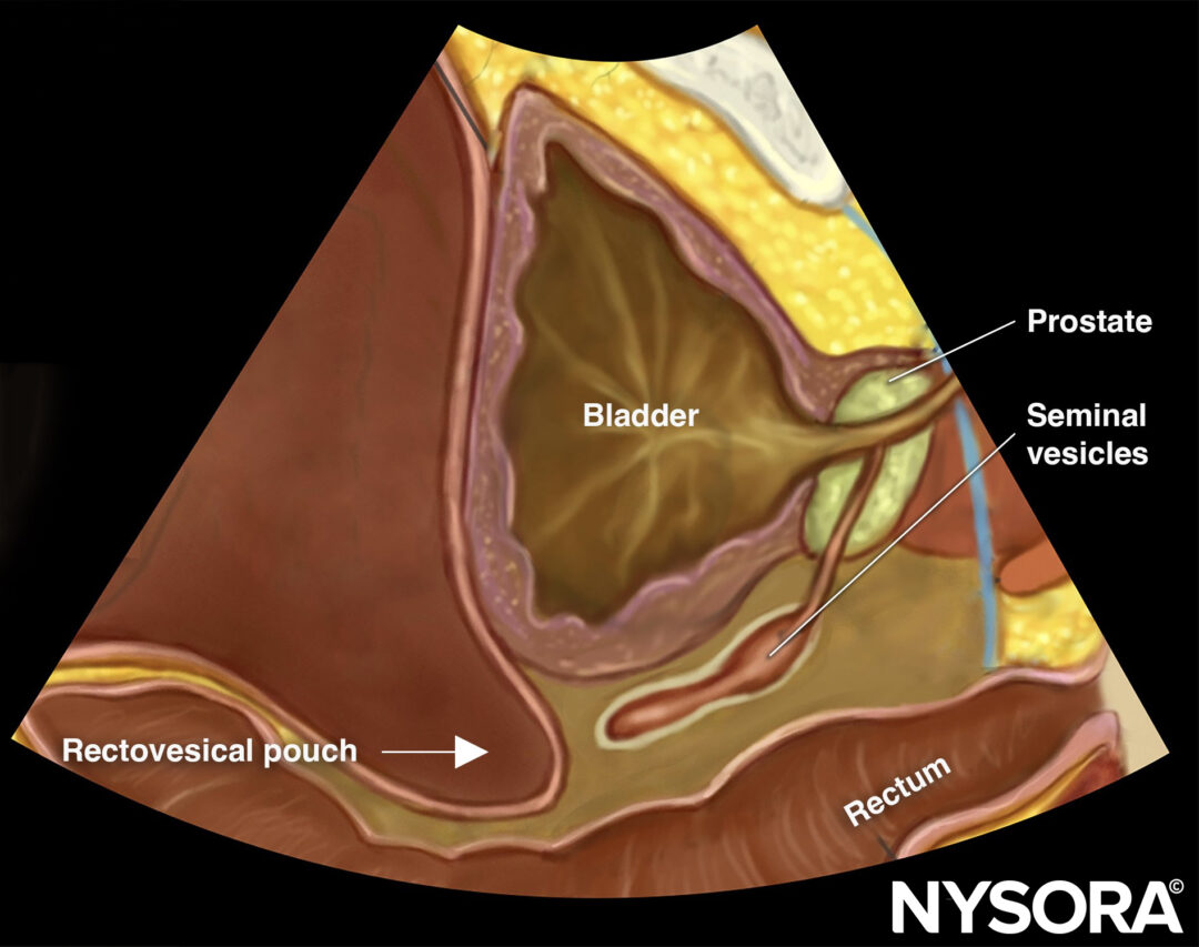 Ultrasound for Foley Catheter: Positioning & Obstruction Identification ...