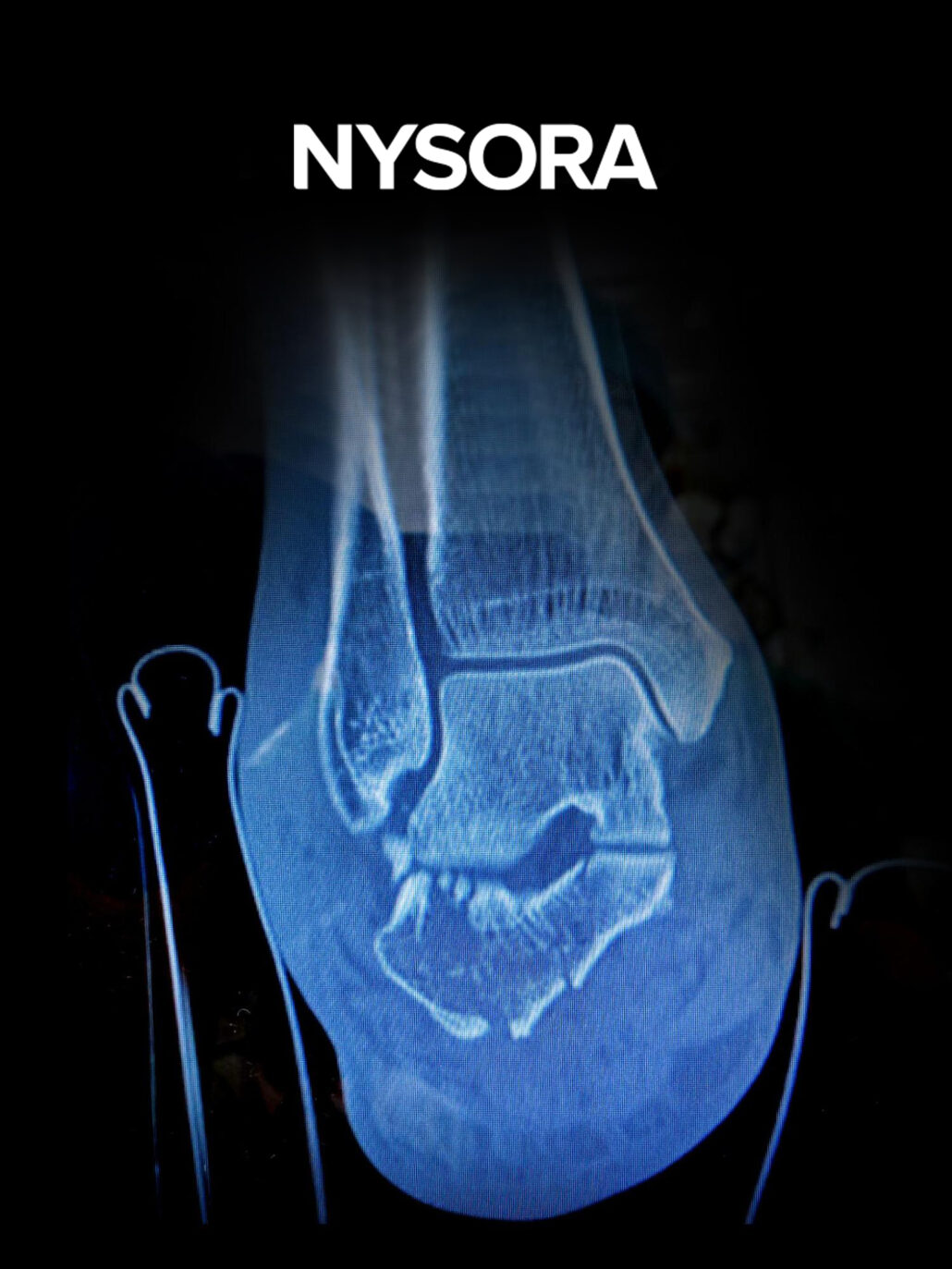 Case study: Calcaneal fracture - NYSORA