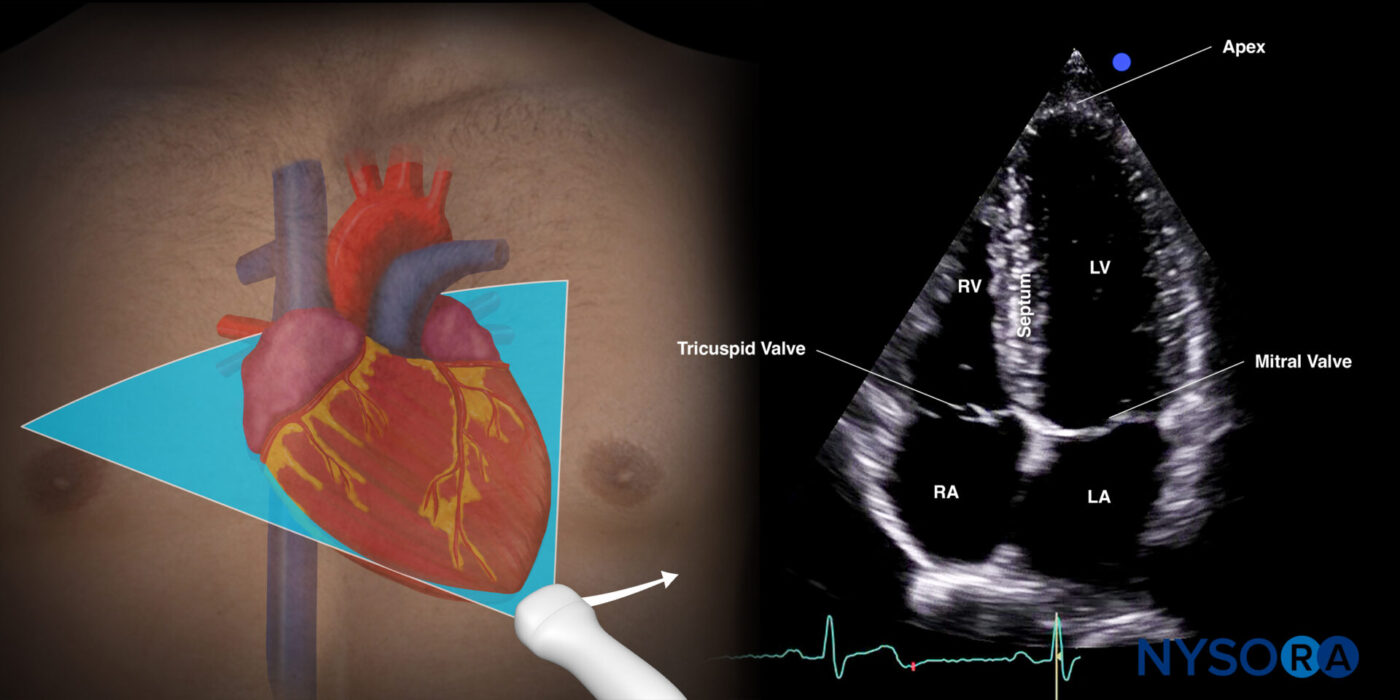 Clinical case: Left ventricular function - NYSORA