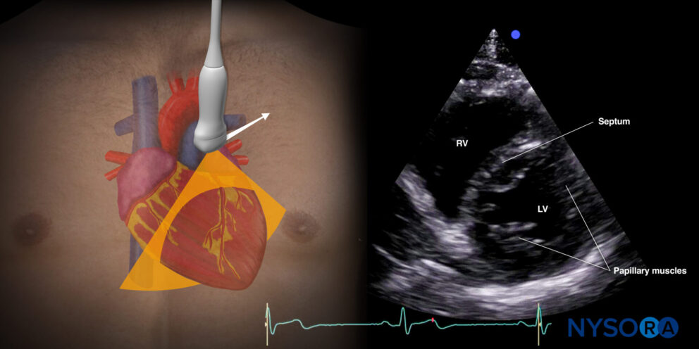 Clinical case: Left ventricular function - NYSORA