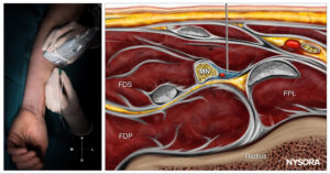 Case study: Flexor tendon release completed under median and ulnar ...