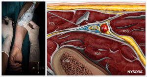 Case study: Flexor tendon release completed under median and ulnar ...