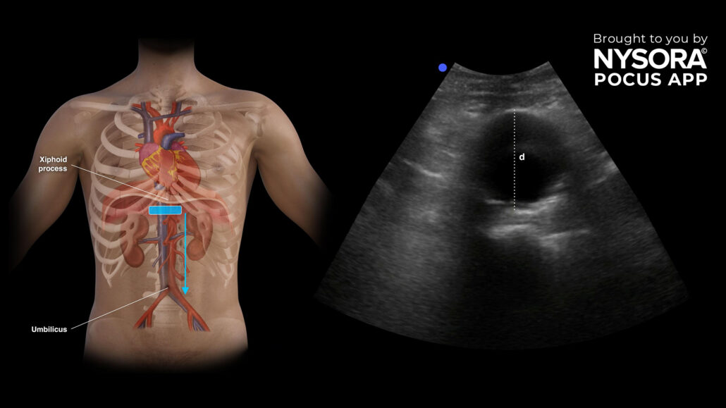Aortic Aneurysm EACTS/STS Guidelines For Diagnosing And Treating Acute