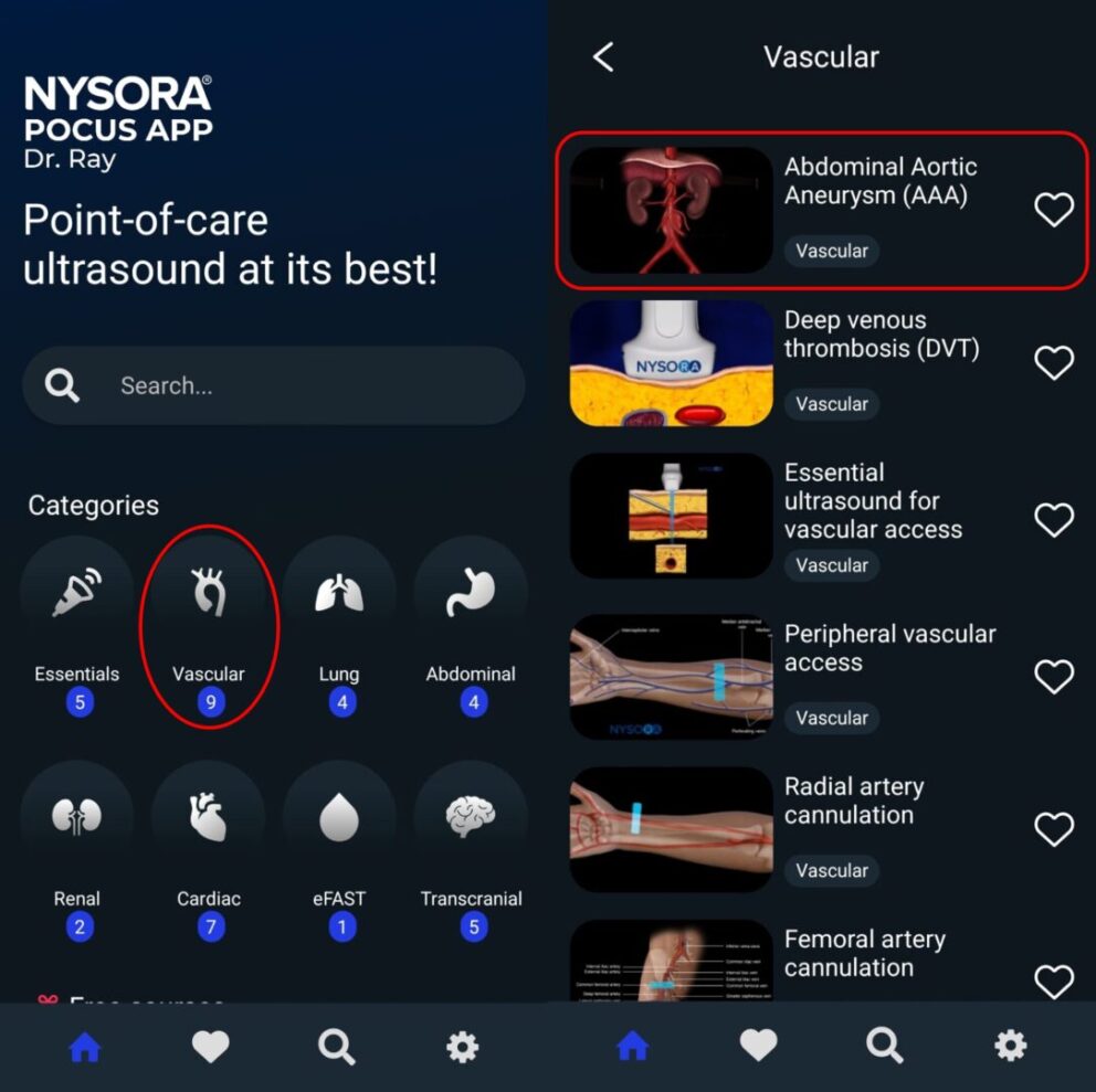 New POCUS course: Abdominal aortic aneurysm (AAA) - NYSORA