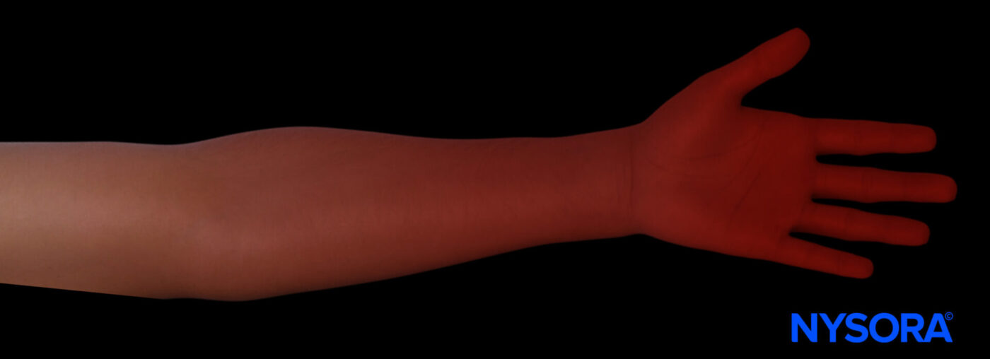 Case study: Upper limb complex regional pain syndrome (CRPS) - NYSORA