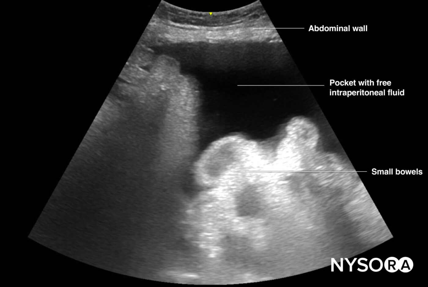 Mastering ultrasound-guided paracentesis: Essential tips for enhanced ...