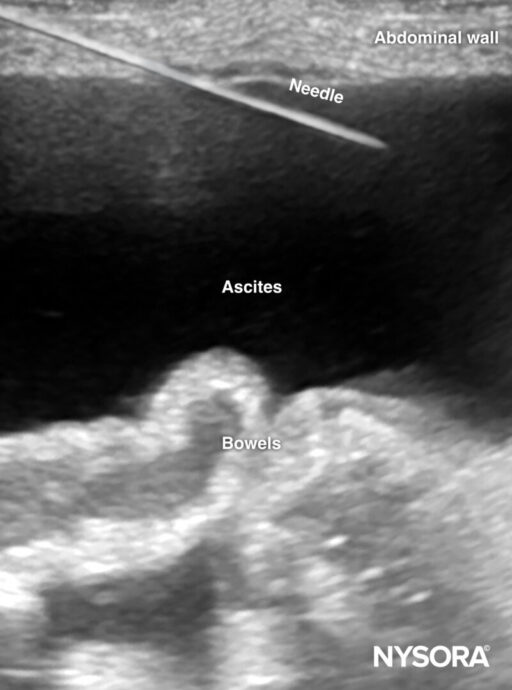 Mastering ultrasound-guided paracentesis: Essential tips for enhanced ...